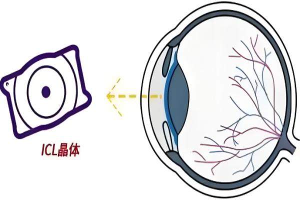 icl晶体v5v4区别:V5夜视上更牛适合角膜偏薄的/V4C矫正范围广性价比高 - 睛安士眼科